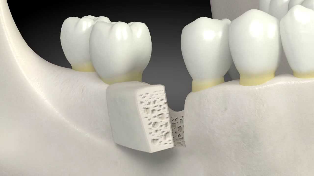 La Greffe osseuse dentaire en amont de la pose d’implant dentaire